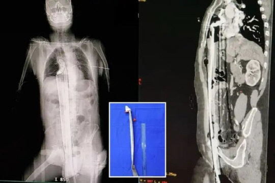 Miraculous Survival Man In Brazil Survives Iron Rod Piercing His Body